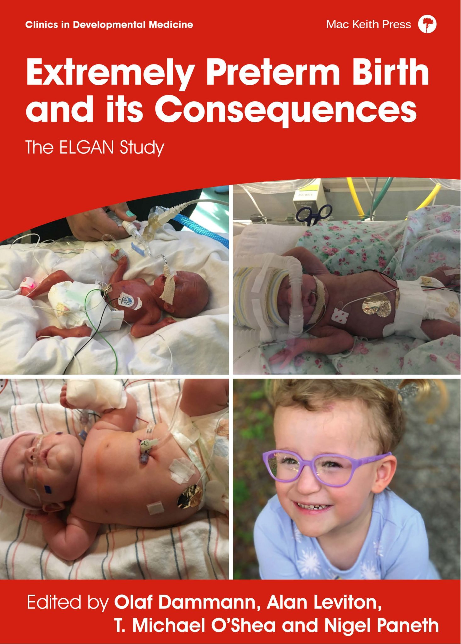 Extremely Preterm Birth and its Consequences - Chapter 11 ...